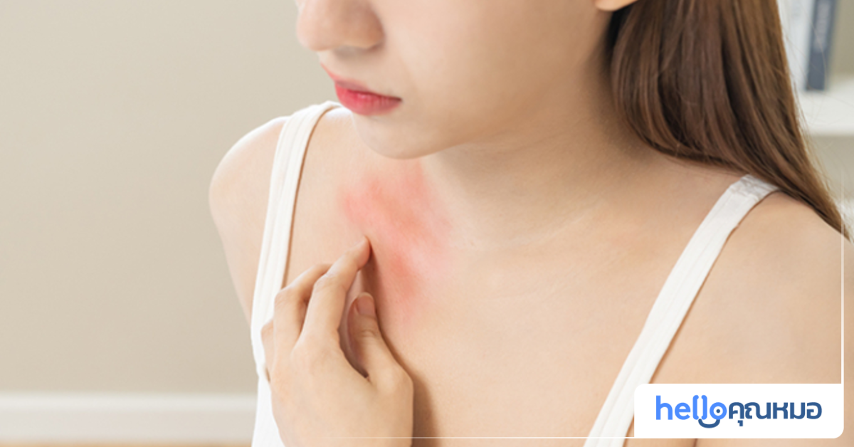 ตุ่มคัน เหมือนยุงกัด เกิดจากอะไรได้บ้าง - Hello Khunmor