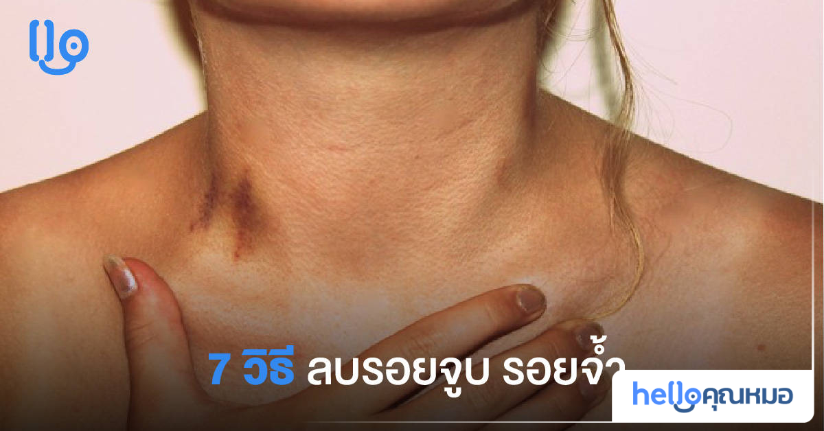 7 วิธีลบ รอยจูบ รอยจ้ำ ให้หายไปอย่างรวดเร็ว - Hello Khunmor