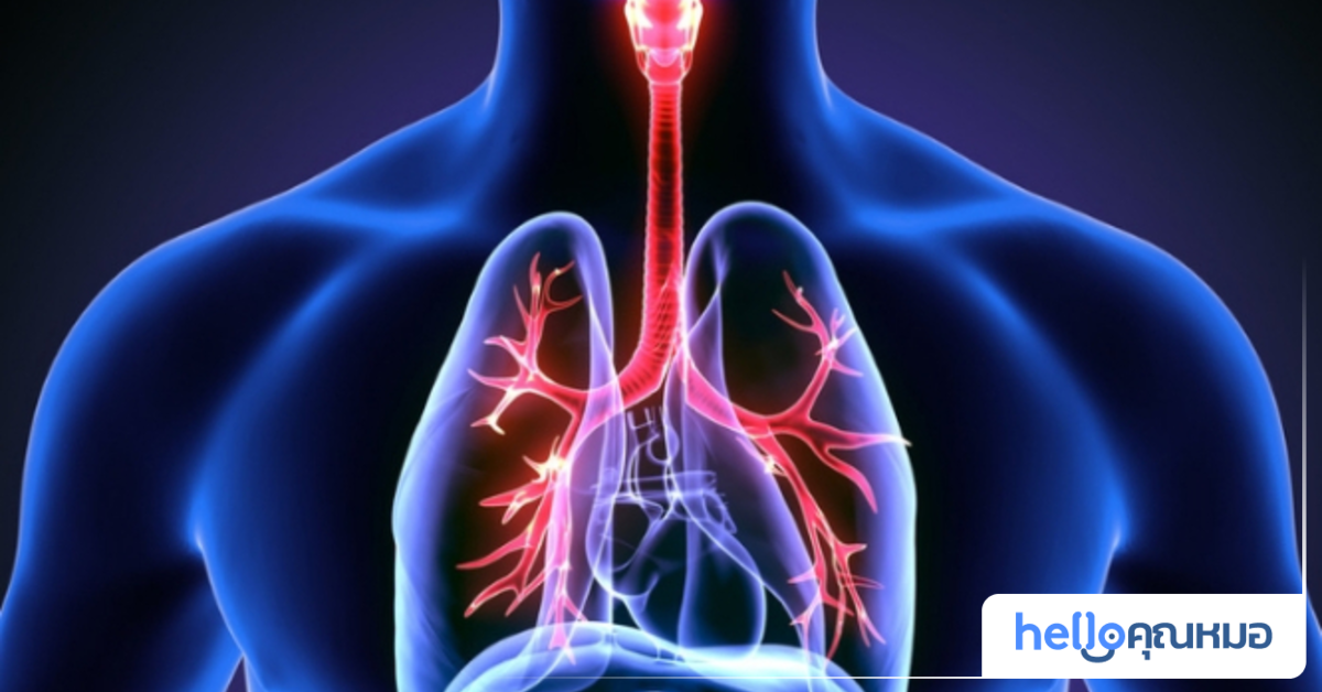 หลอดลมโป่งพอง (Bronchiectasis) - Hello Khunmor
